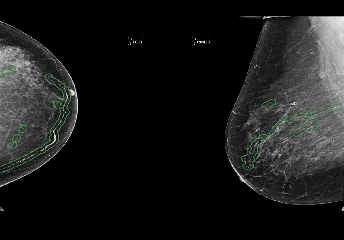 Mammograms may reveal hidden heart risks for women, Penn State study ...